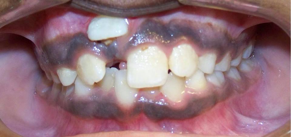Ectopic eruption | Premiere Orthodontics